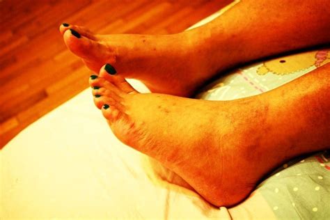 Amlodipine Side Effects