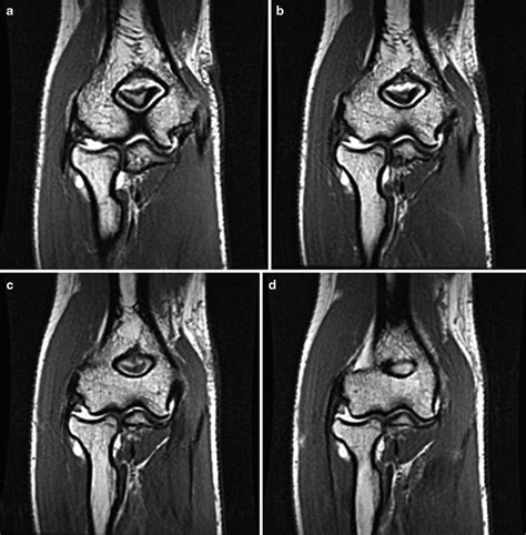 Elbow Injuries In The Overhead Athlete Mucl Avulsion And Tears