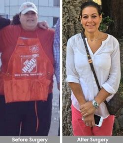 Emory Bariatric Surgery Before And After Weight Loss Surgery