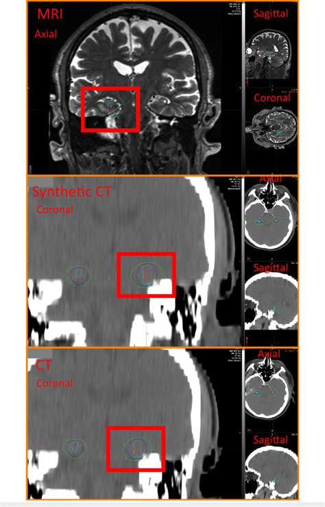 Representation Of Srs Plans For Single Metastasis Brain Tumor Orange