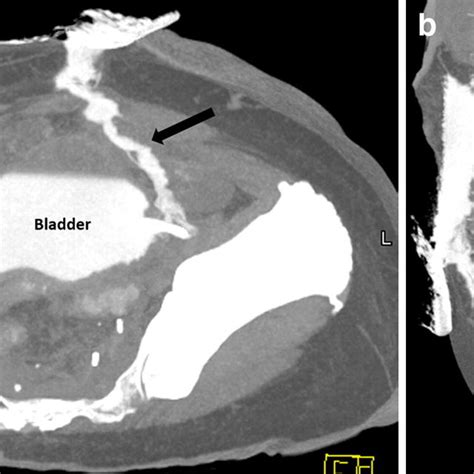 Ct Cystogram Images In A 60 Year Old Female With A Previous History Of