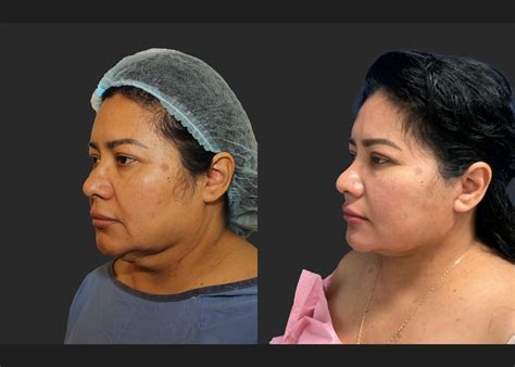 Faceliftnecklift Before And After Photos Zamani Plastic Surgery Dr