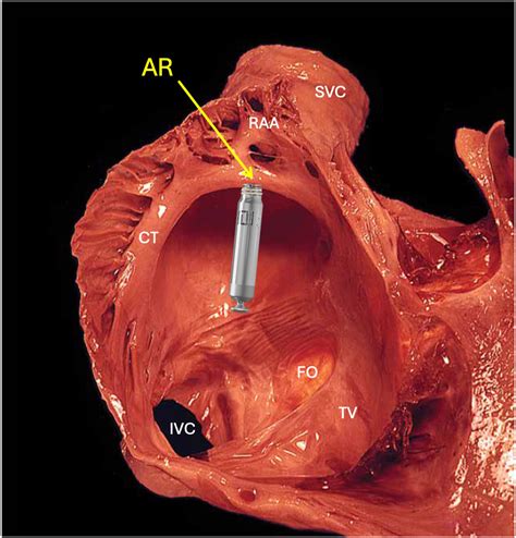 Intracardiac Echocardiography Guided Implantation Of An Atrial Leadless