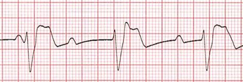 3rd Degree Heart Block Photos Idea