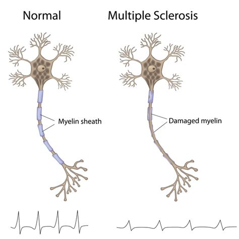 Multiple Sclerosis Medlineplus Genetics