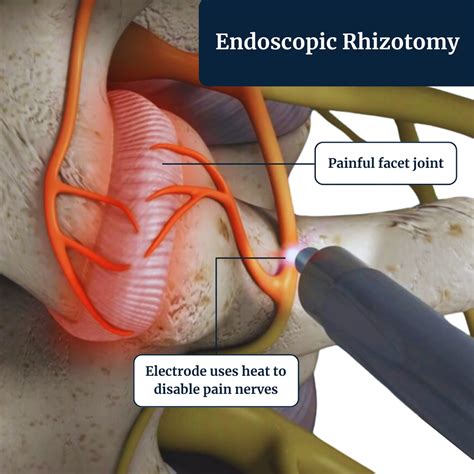 Endoscopic Rhizotomy In Irving Tx And Dallas Tx Gottlieb Spine