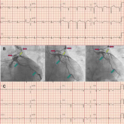 A Initial Electrocardiogram Ecg Showing St Elevations In