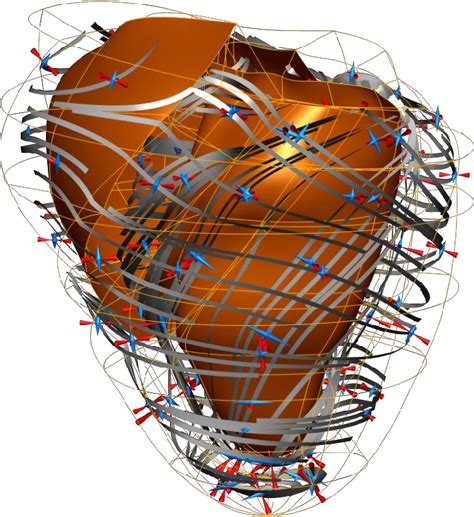 Figure 1 From Advanced Electrocardiography Identifies Patients With False Positive Exercise