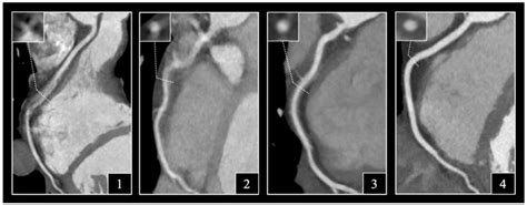 Representative Curved Multiplanar Reconstructions And Corresponding