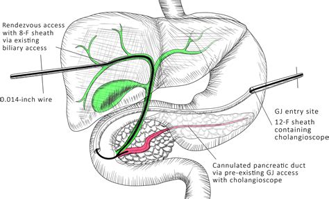 Percutaneous Cholangioscopy Assisted Placement Of A Pancreatic Duct
