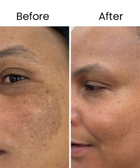 Face Prp Treatment Before After 3d Lifestyle Pk 3d Lifestyle Pk