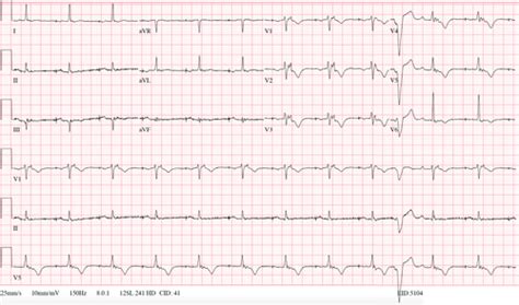 21yearold Male With Transient Abnormal Ecg American