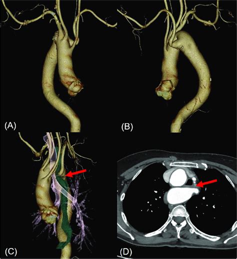 Preoperative Volume Rendering Computed Tomography Ct Image Of Download Scientific Diagram