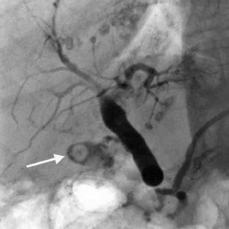PDF Cholecystitis After Cholecystectomy