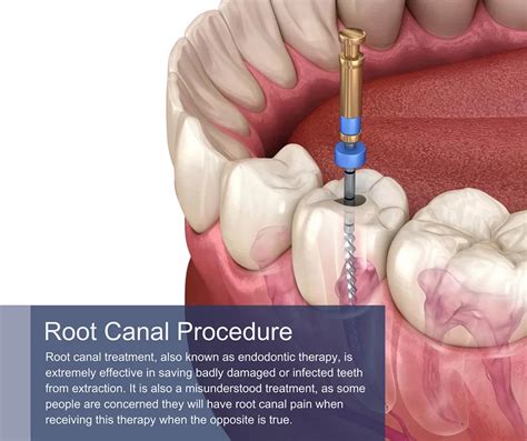 Root Canal Therapy NYC Endodontic Treatment In Midtown Manhattan And Downtown Brooklyn