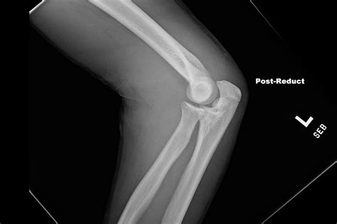Orthodx Elbow Dislocation Clinical Advisor