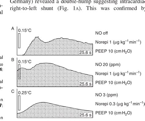Transpulmonary Thermodilution Curve Before And During No Treatment A Download Scientific