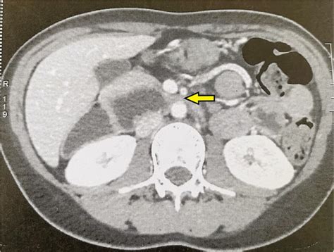 Cta Showing Compression Of The Third Duodenal Portion By The Superior Download Scientific