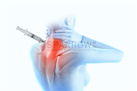 Trap Botox Vancouver