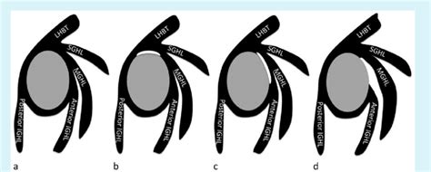 Schematic Illustration Of A The Normal Capsulo Ligamentous Labral Download Scientific Diagram