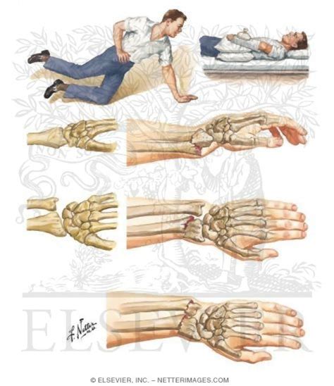 Extension Compression Fracture Of Distal Radius Colles Fracture