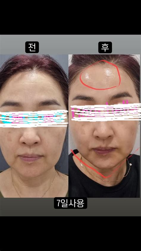 코챌라 프로컨닥터 평택 바디채움빚다 대표원장 이혜진 1일후기 7일후기 ⠀ 이정도면 보톡스 안맞아도 되죠 ⠀ 쁘띠시술도 많이 하면 피부조직 손상 변형