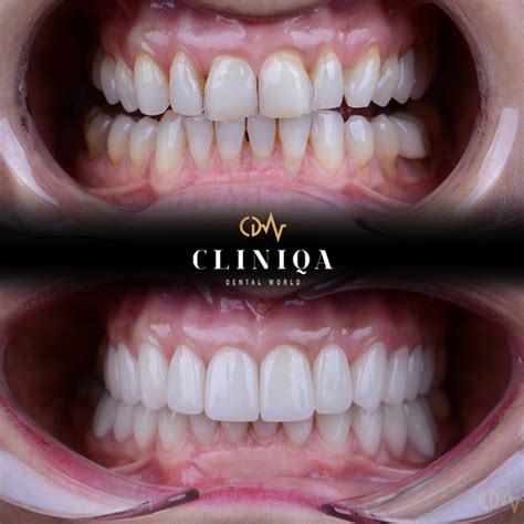 قبل وبعد Before And After Photos Of Dental Treatments عيادة أسنان