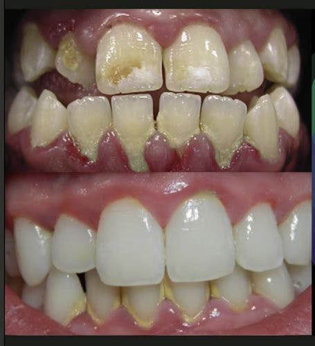 Clinic Scaling Root Surface Debridement And Ultrasonic Scalers