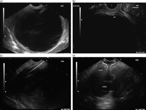 Hot Axios Lams Insertion A 7 Cm Pseudocyst B 5 6 Mm Wall Between Download Scientific