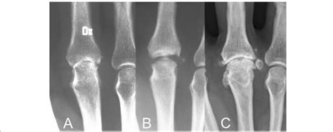Radiographs Ap View Of The Third Metacarpophalangeal Joint In The Download Scientific Diagram