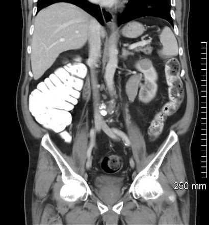 Papillary Renal Cell Carcinoma Radiology Reference Article Radiopaedia Org