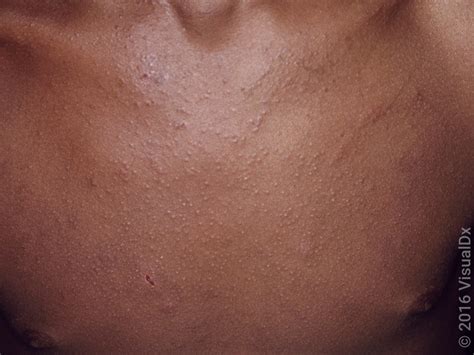 Scabies Rash On Chest Stress Rash What Is It And How To Treat It