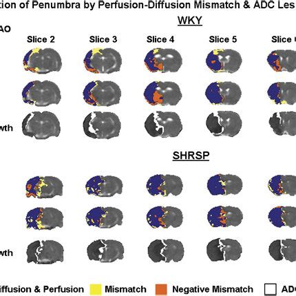 Spatial Distribution Of Perfusion Diffusion Mismatch Across Six Coronal Download Scientific