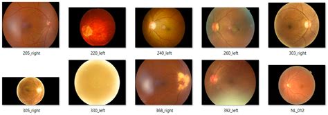 Electronics Free Full Text Enhancing Cataract Detection Through