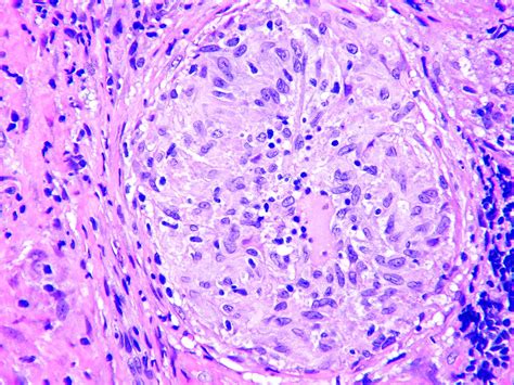 Flickriver Photoset Sarcoidosis Necrosis In Granulomas By Pulmonary