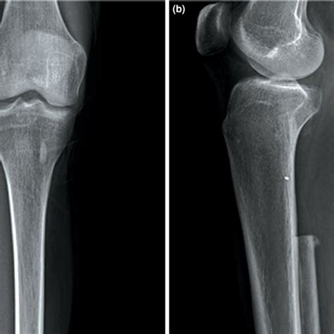 Intraoperative Image During En Bloc Resection Of Proximal Fibula A Download Scientific