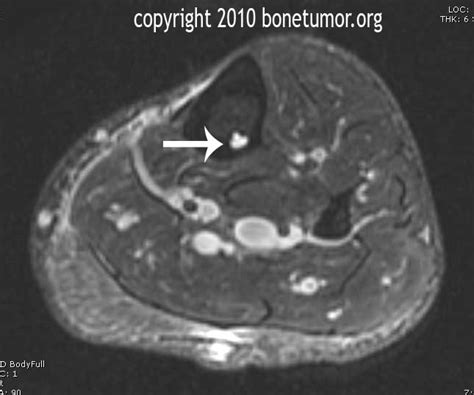 A Vascular Mass On The Front Of The Tibia