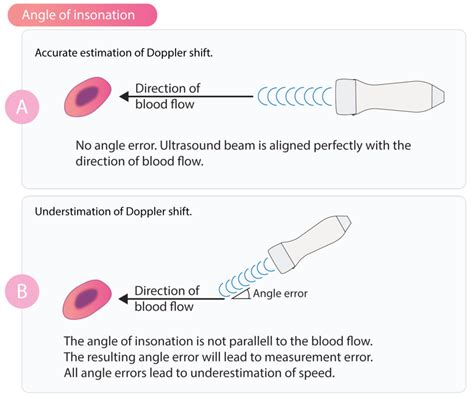 Doppler Effect And Doppler Echocardiography Cardiovascular Education