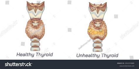 Hypothyroidism Vs Hyperthyroidism Healthy Unhealthy Thyroid Stock Vector Royalty Free