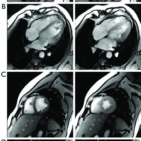 Real Time Phase Contrast Flow Mri 3 T 40 Ms Quantitative Download Scientific Diagram