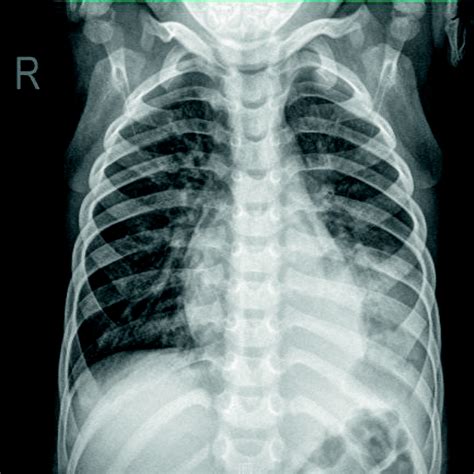 Atelectasis Appearance On Chest X Ray At Ryder Sidaway Blog