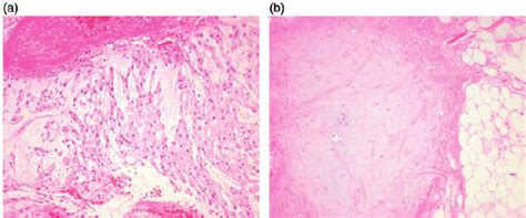 Tumor Histopathology A Classic Chordoma Areas Showing Groups Of Download Scientific Diagram