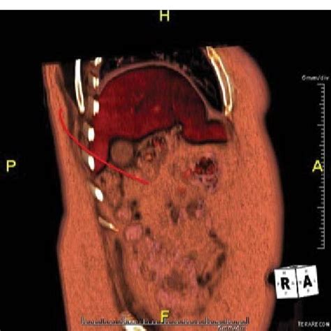 3d Ct Reconstruction Demonstrating Extent Of Hemidiaphragm Elevation Download Scientific Diagram