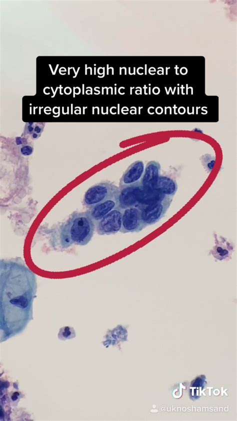Uknoshamsand On Instagram Hsil Severe On A Pap Smear Cells Cytology