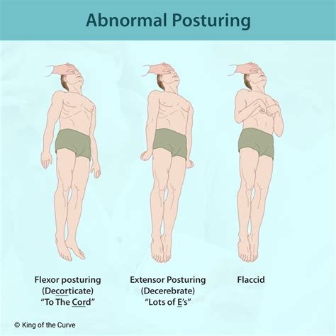 Abnormal Posturing Nclex Guide Decorticate Vs Decerebrate Vs Flaccid