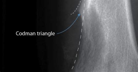 Codman Triangle A Distinctive Triangular Form Of Periosteal Reaction