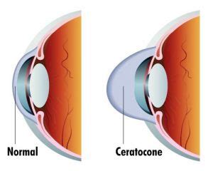 Ceratocone Hospital De Olhos C R O