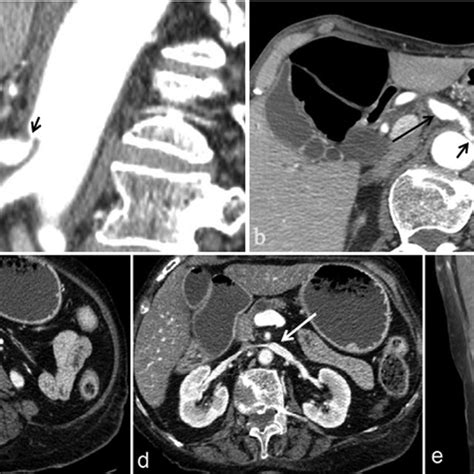Cta Sagittal Plane Of A Patient With Mals Taken In Deep Expiration An Download Scientific