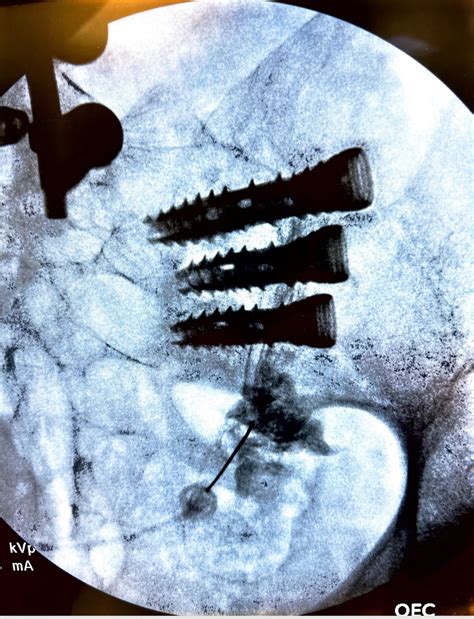 Description The Si Bone Triangular Fixation Device Involves The Insertion… Paul Hubbell Iii