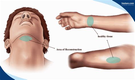 Microvascular Free Flap Reconstruction Surgery For Head And Neck Cancer Treatment Vaidam Health